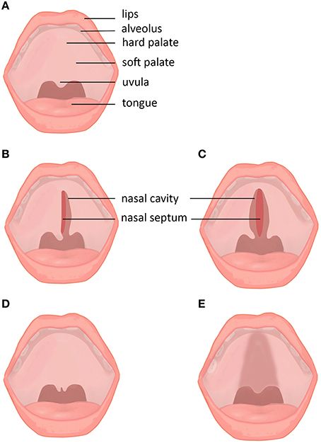 cleft soft palate speech problems