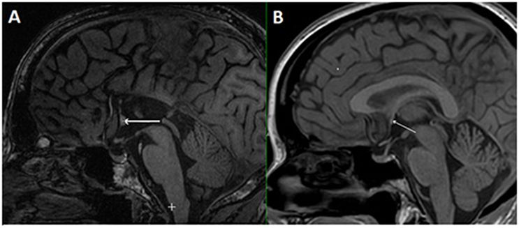 corpus callosum function while driving