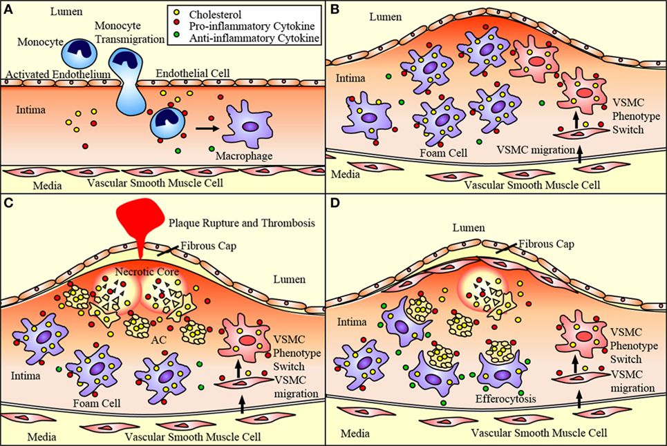 atherosclerosis process formation