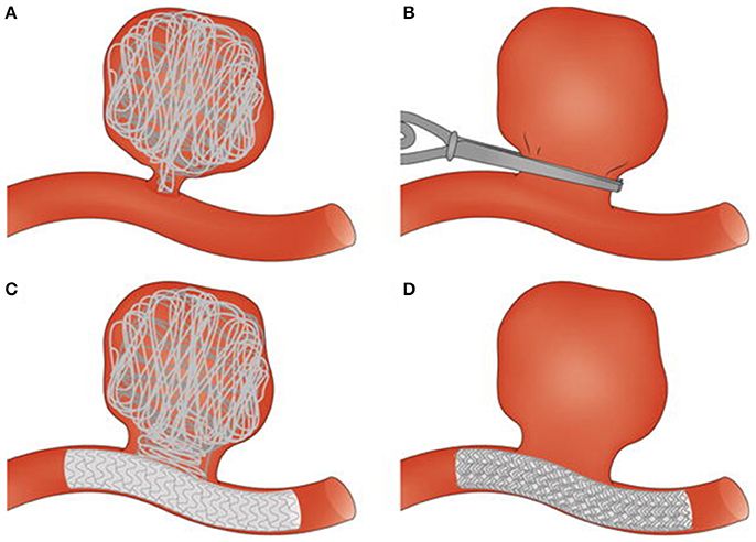 embolisation aneurysm