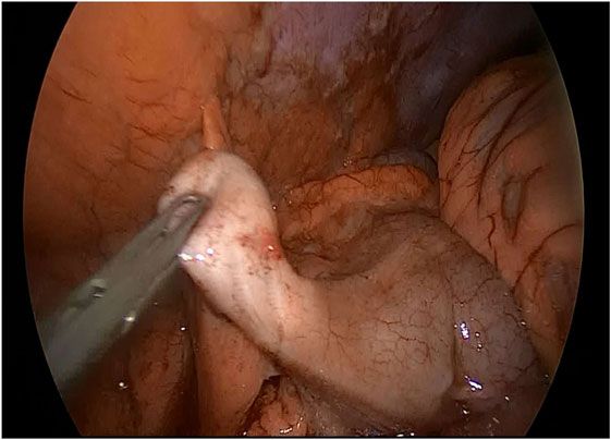 peritonei pseudomyxoma