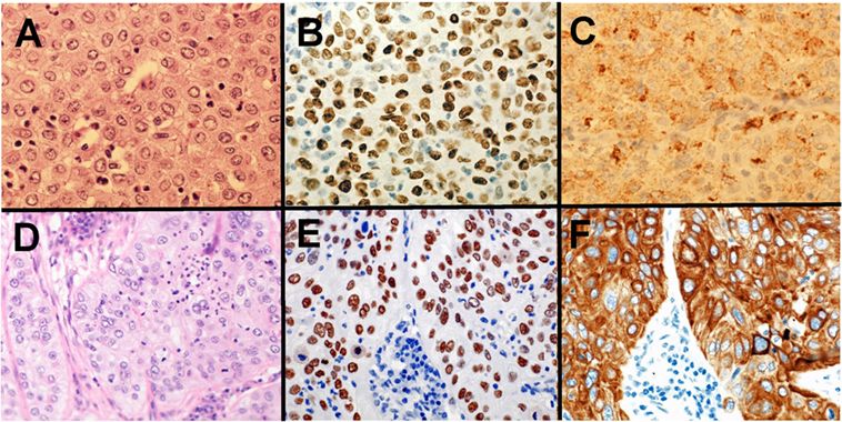 lung cancer histology prevalence