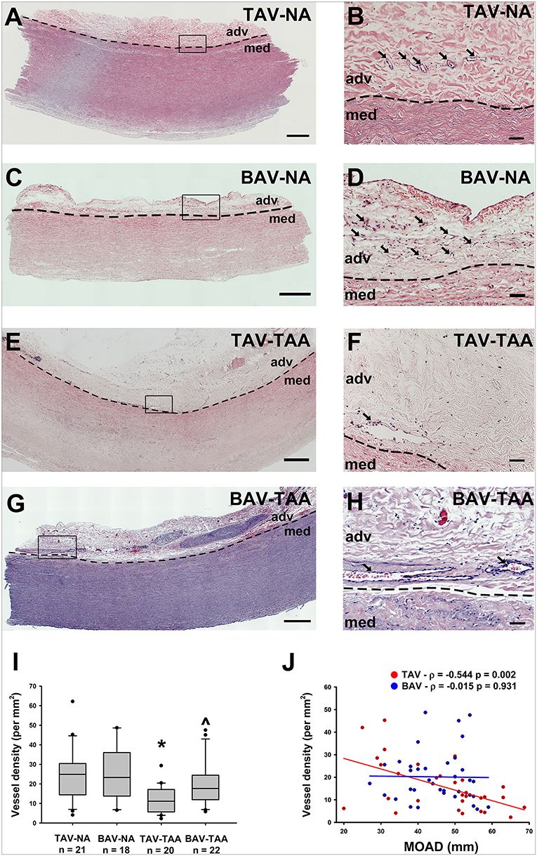 vasa vasorum syphilis