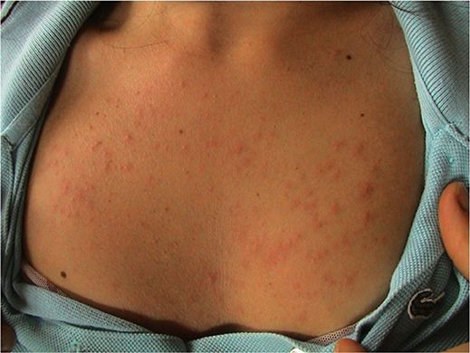 polymorphous light eruption face