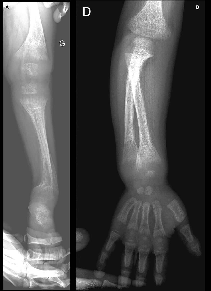 rickets bone findings