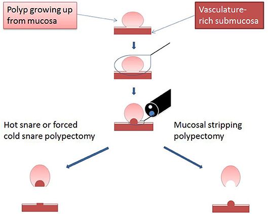 rectal polypectomy procedure