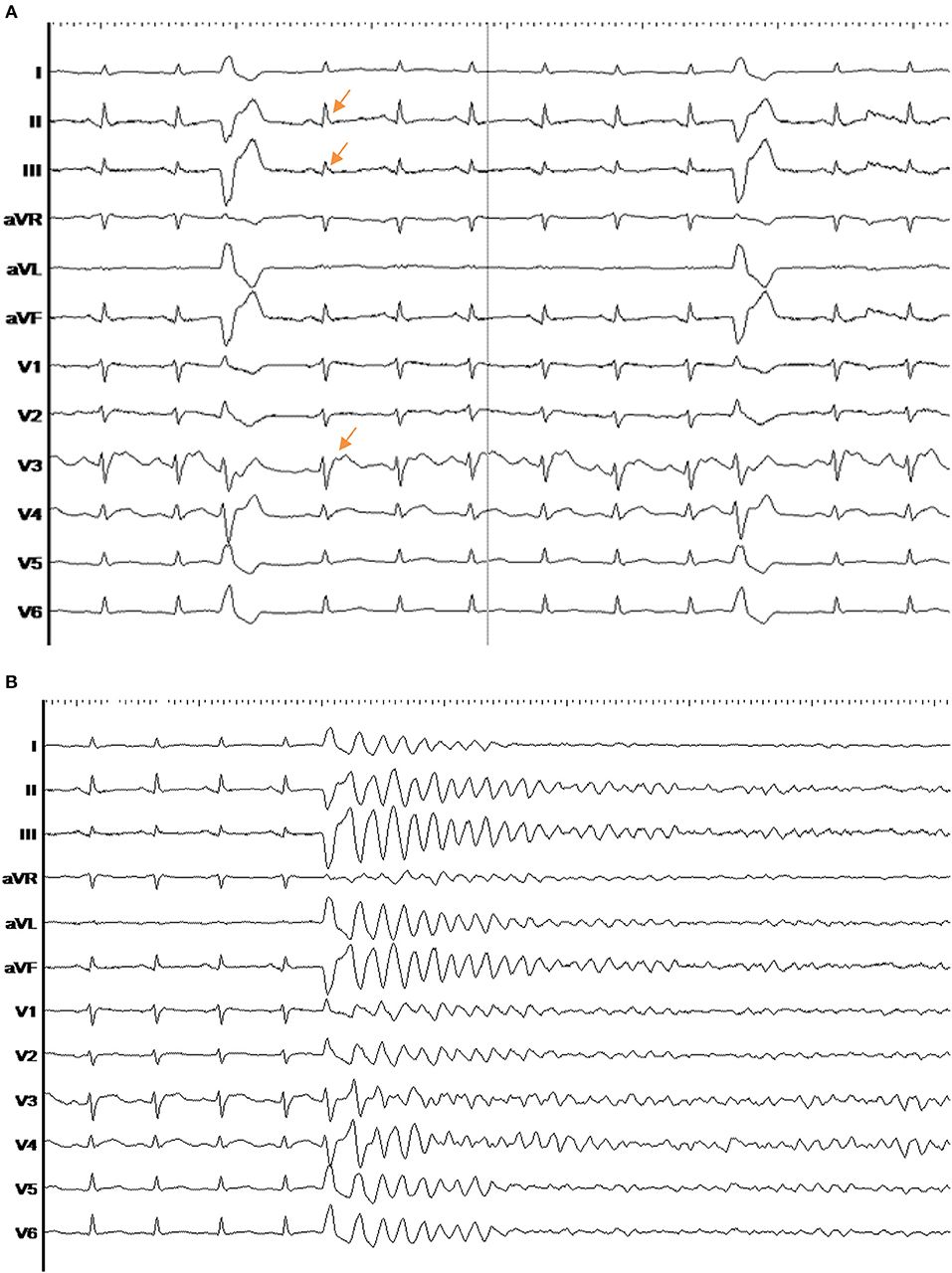 repolarization ecg changes