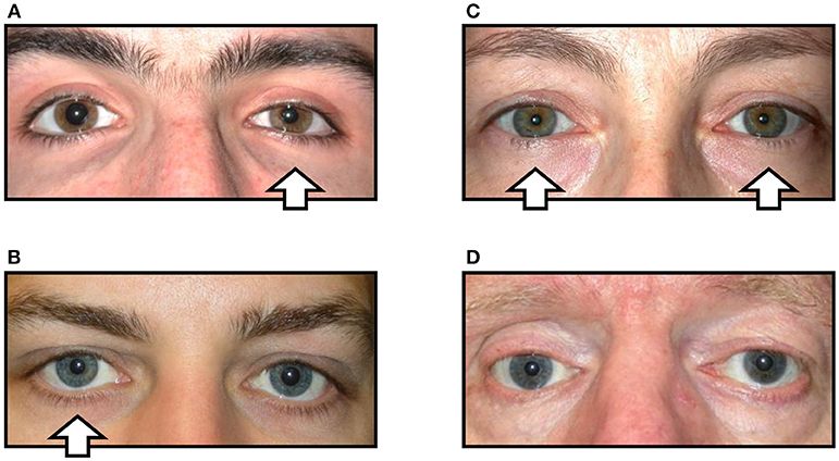 opiates effects on eyes