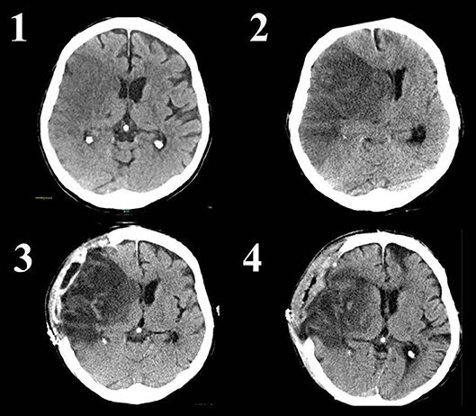 decompressive hemicraniectomy stroke