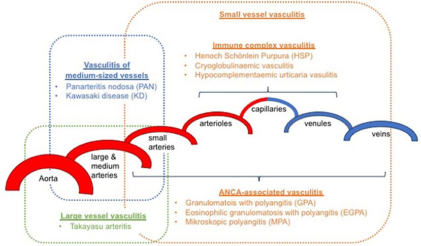 paraprotein vasculitis