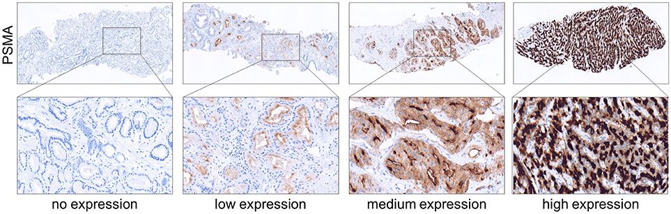 intense psma expression
