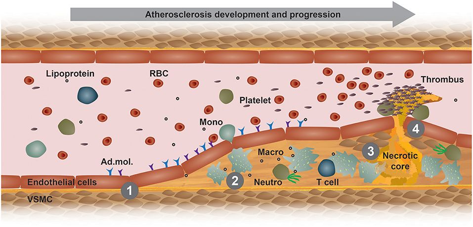 atherosclerosis progression