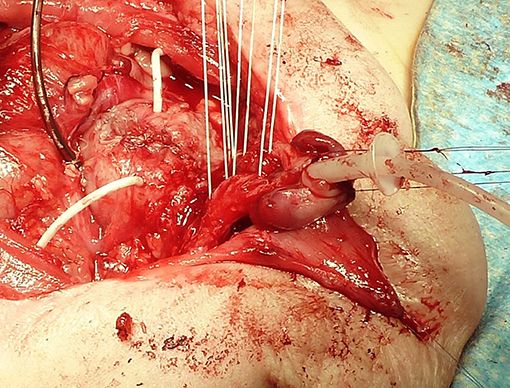how common is bladder exstrophy