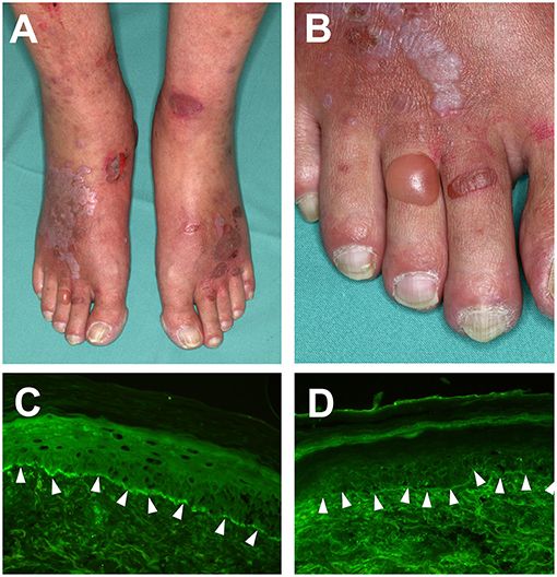 bullous lichen planus code