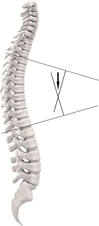 thoracic kyphosis angle