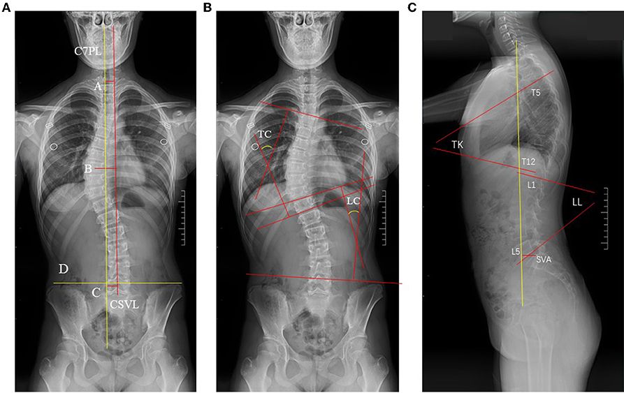 coronal plane deformity