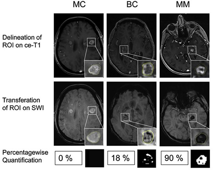 swi mri protocol