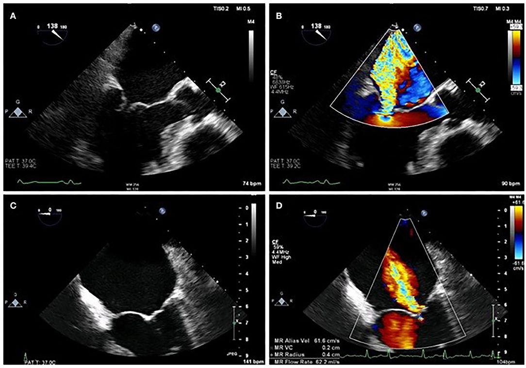 normal mitral valve gradient on echo