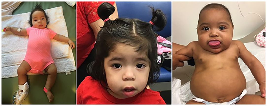 beckwith wiedemann syndrome adulthood