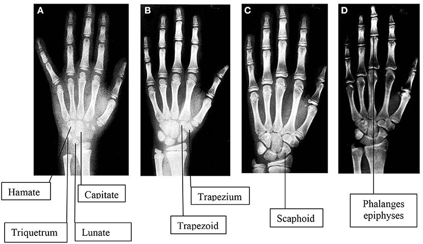 normal bone scan pediatric