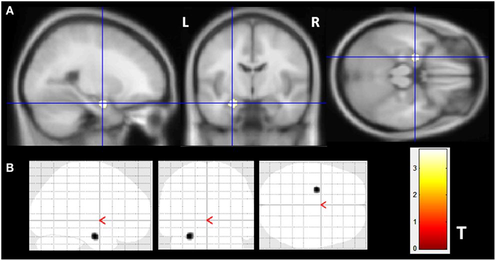 amygdala hyperintensity mri