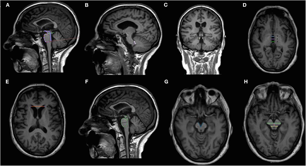 progressive supranuclear palsy