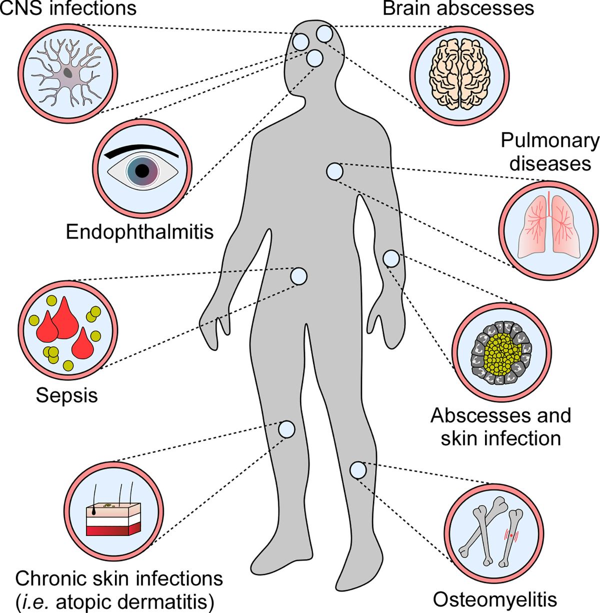 staphylococcus aureus causes