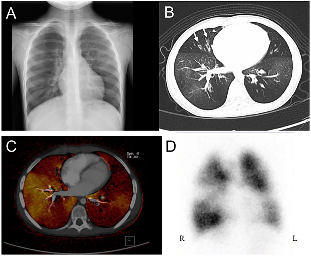 bronchiolitis x ray changes