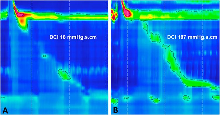 scleroderma esophagus manometry