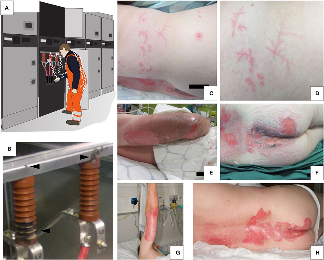 electrocution burn injuries