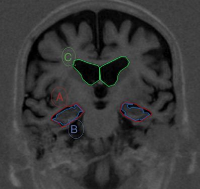 mesial temporal atrophy