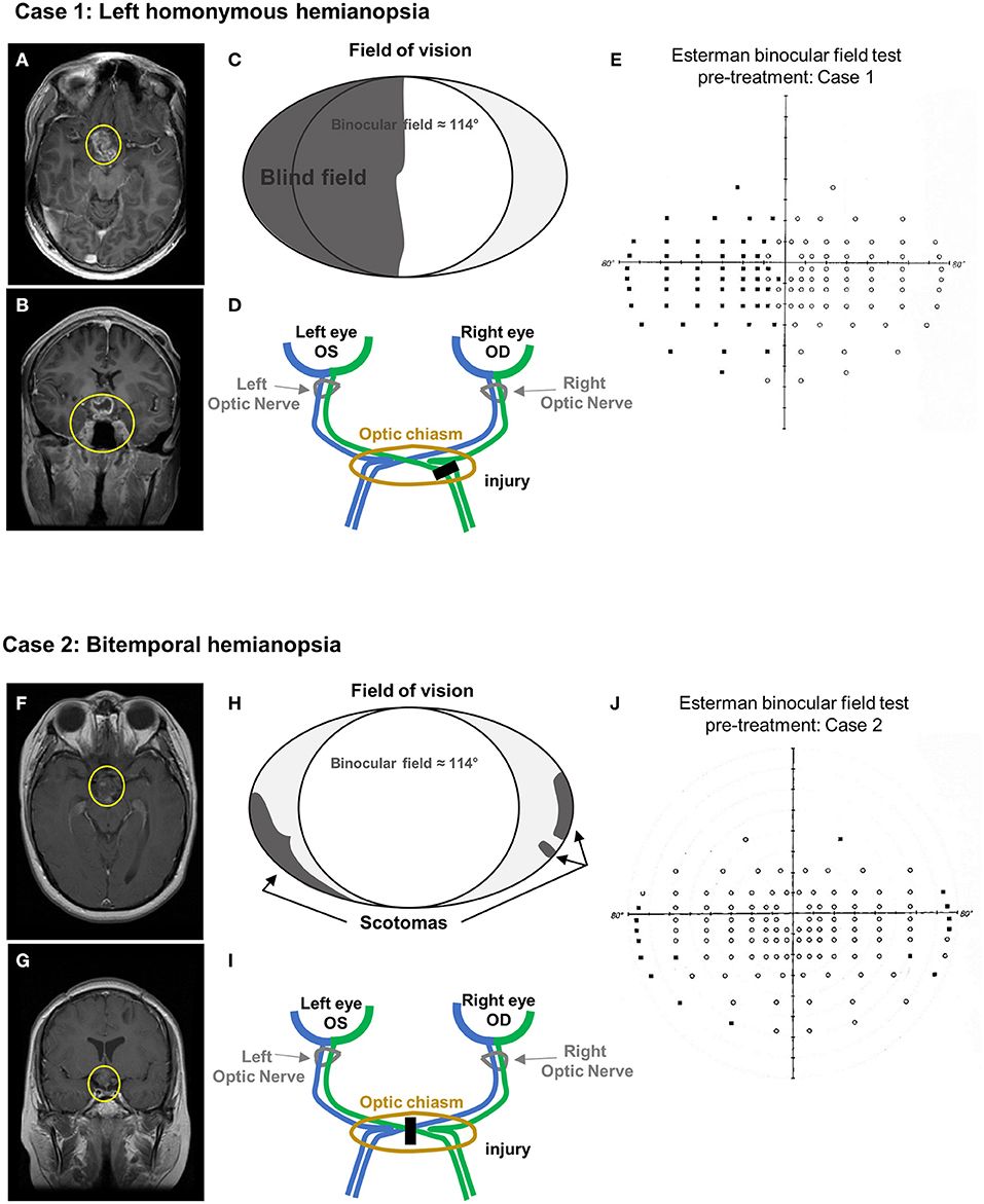 bilateral hemianopia causes