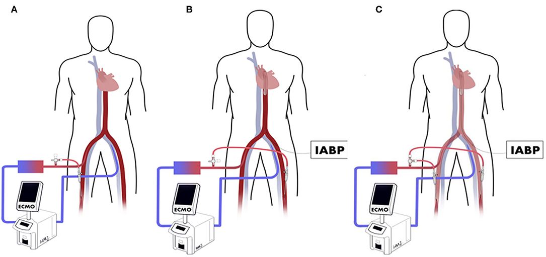 va ecmo cannula