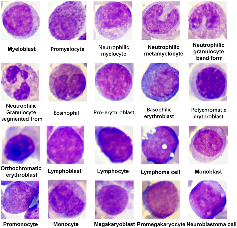 Metamyelocyte Vs Monocyte