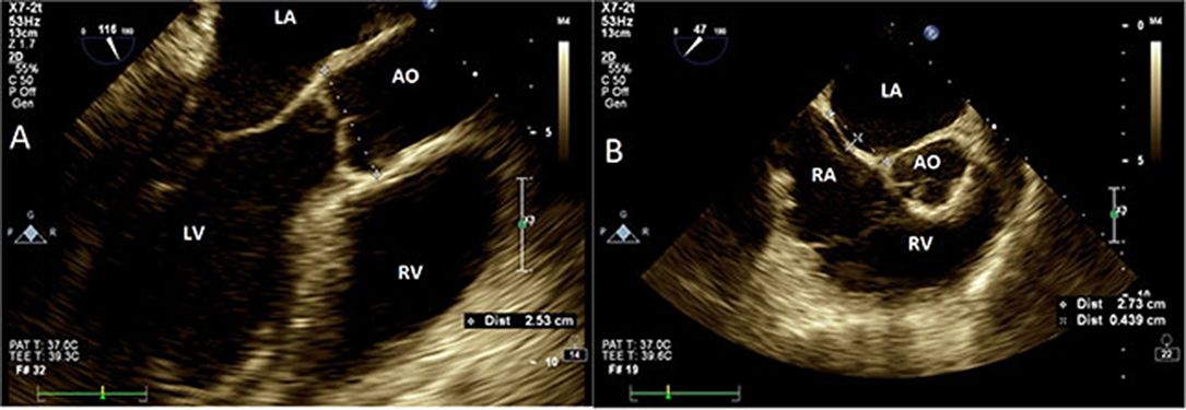 aortic root dilation echo