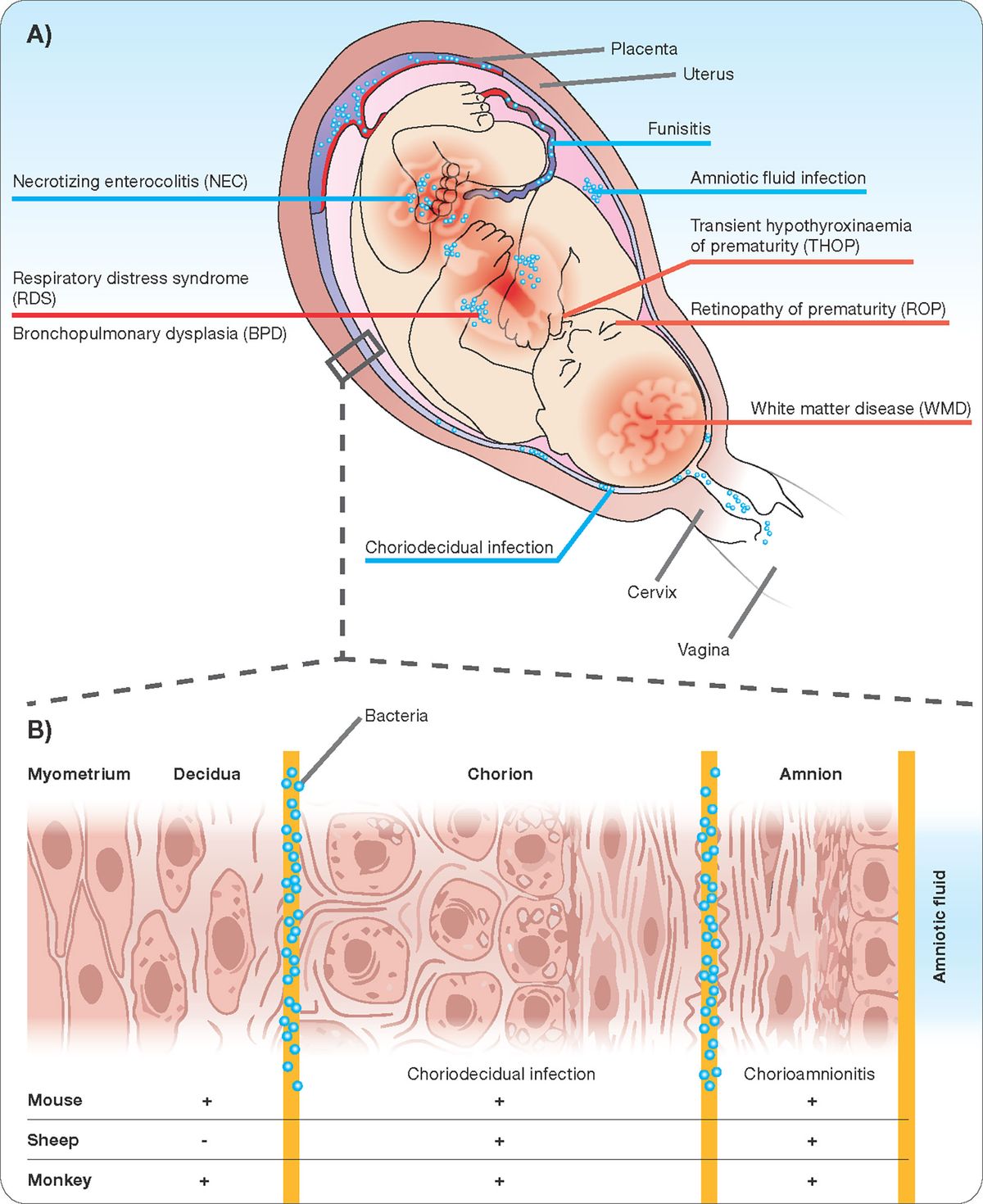 chorioamnionitis gross