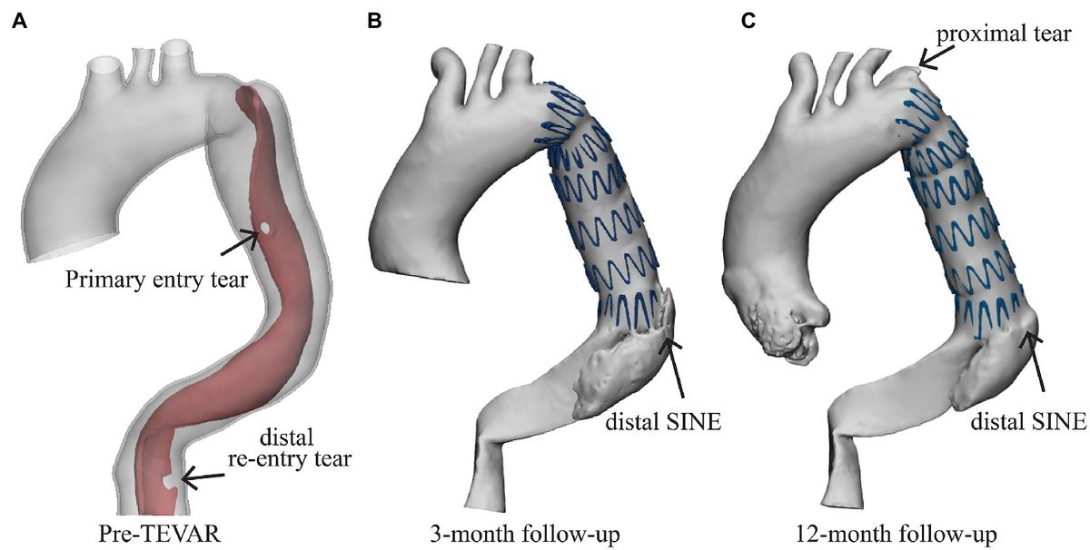 interposition graft aorta