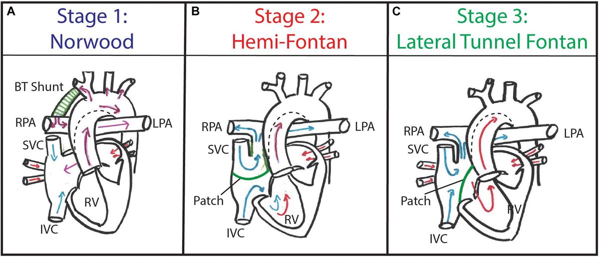 fontan procedure survival rate
