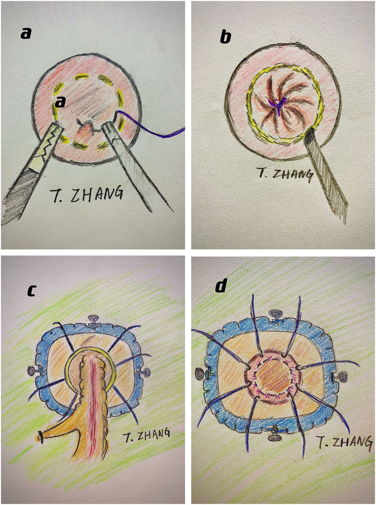 total mesorectal excision cpt code