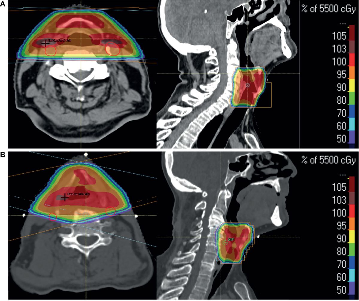 preepiglottic space ct