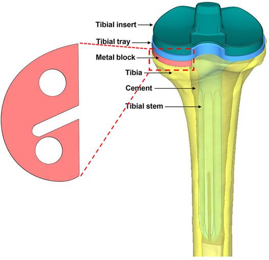 offset stem tibia