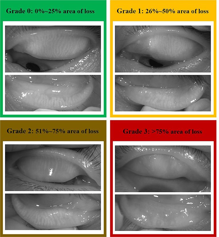 meibomian gland observation