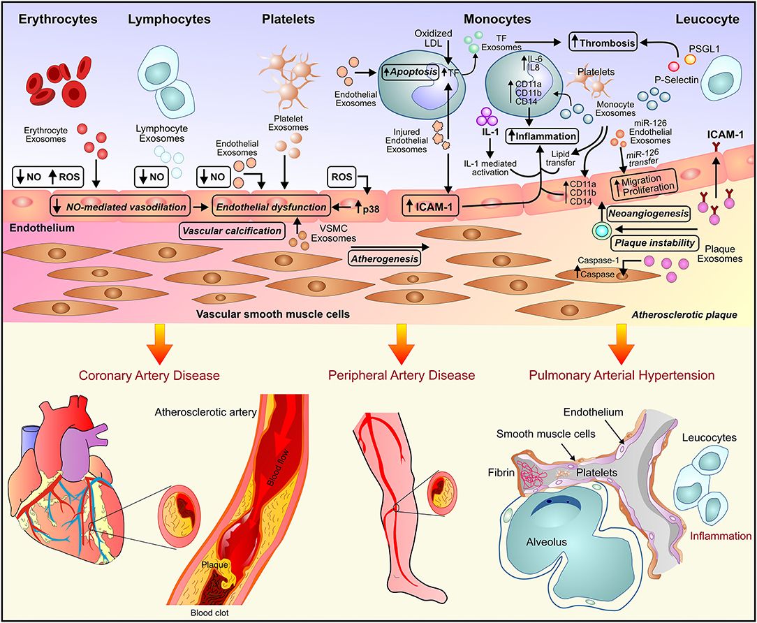 atherosclerosis pathogenesis calgary
