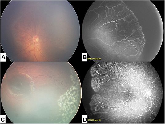 retinopathy of prematurity grade 3