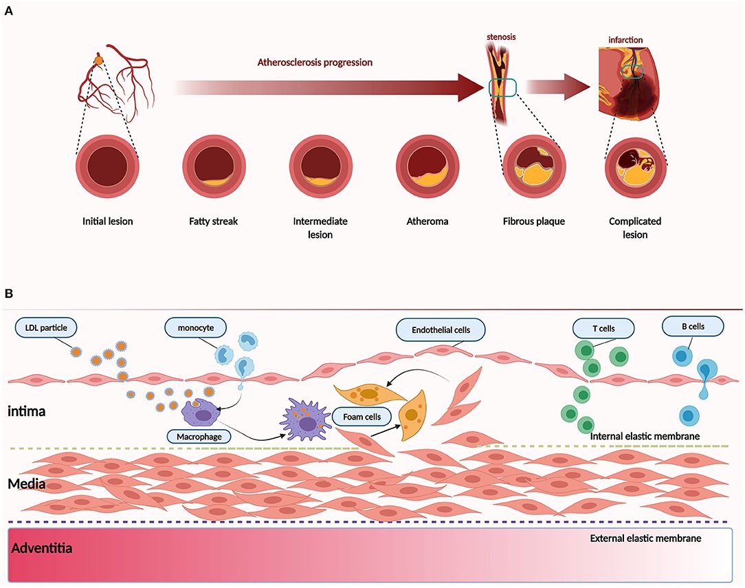 atherosclerosis progression steps