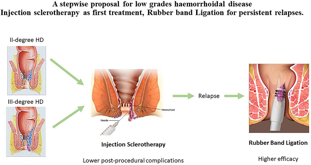 piles initial treatment