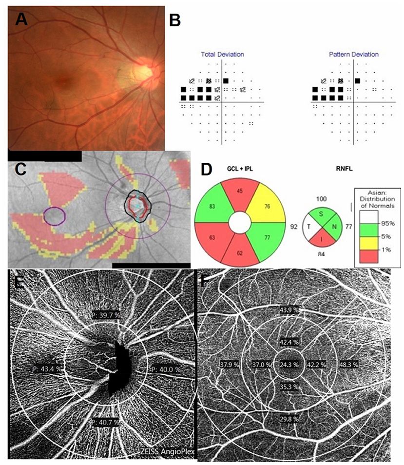 glaucoma octa