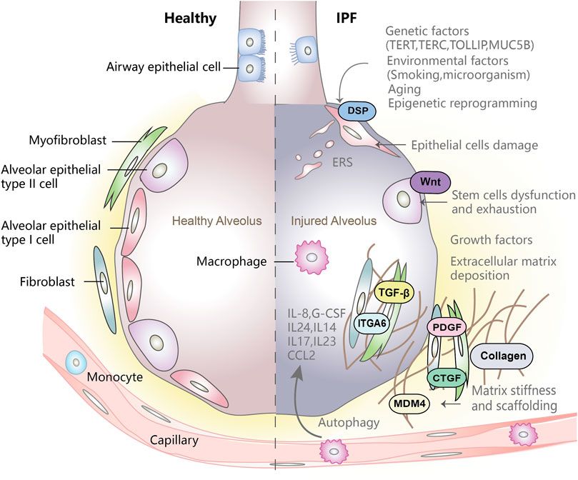 fibrosis pulmonary