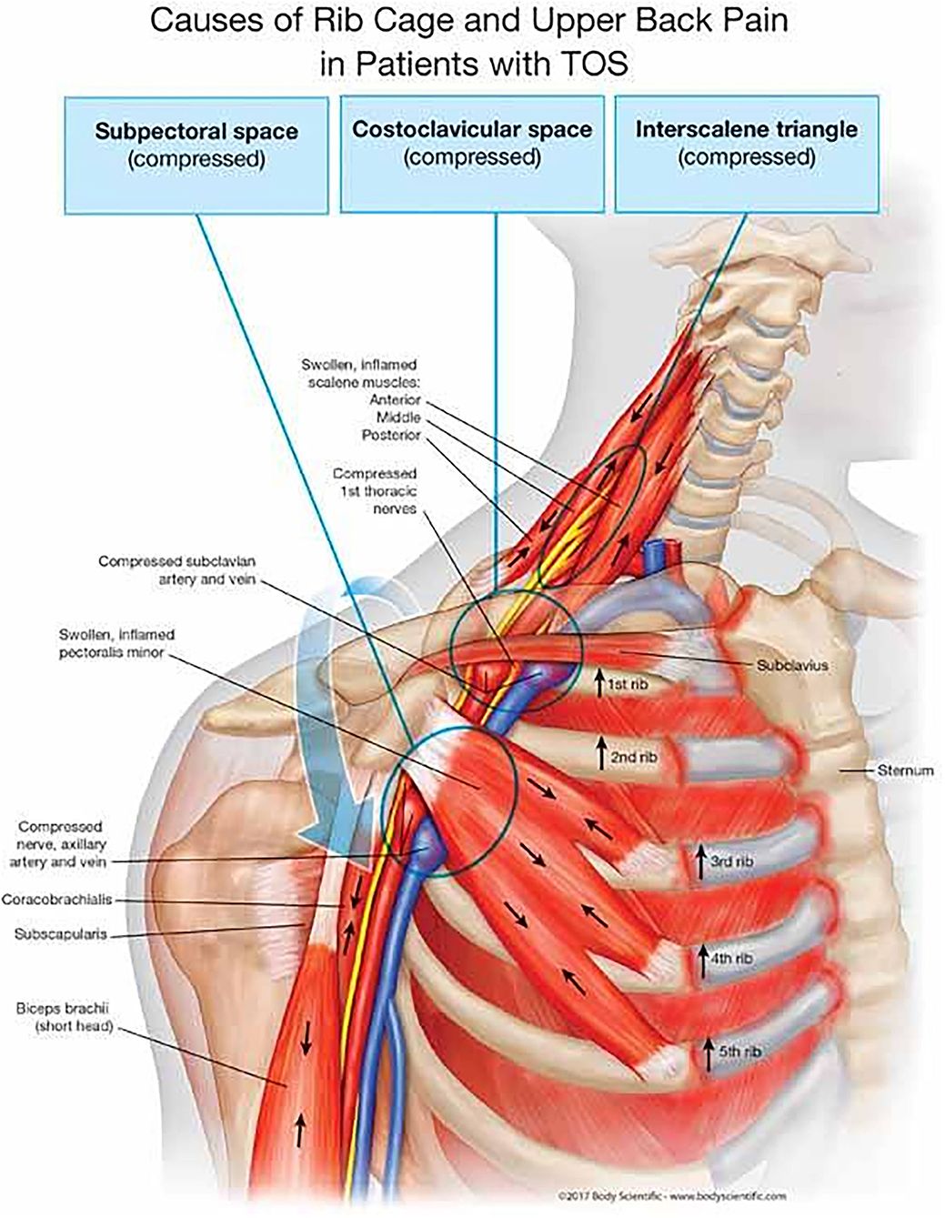 what is a thoracic outlet surgery