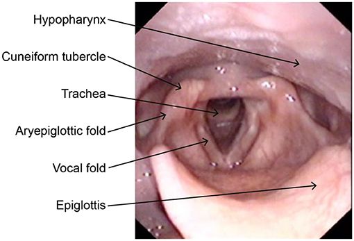 normal larynx scope